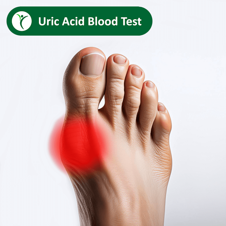 Uric Acid Blood Test | Check for Gout, Kidney Stones & Metabolic Healt ...